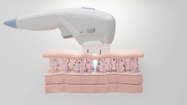 What is HIFU? | liftique.co.uk